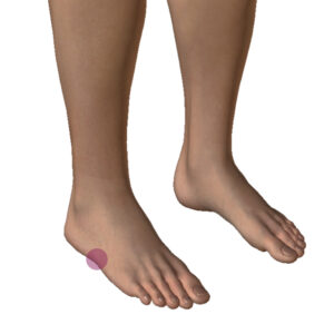 子どもの足の外側が痛い!?第5中足骨粗面部骨端症（Iselin病） ‣ はやし鍼灸整骨院